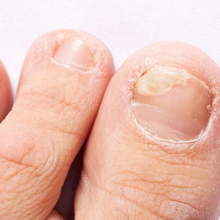 Onicomicosis - Club de la Farmacia - Comunidad de farmacéuticos y ...